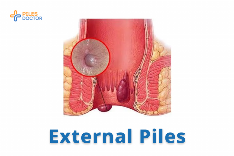 External Piles Treatment - Home Remedies, Surgery & Recovery